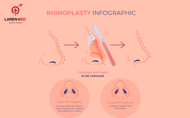 Open vs. Closed Rhinoplasty: Which Method Is Right for You? - Laren Med
