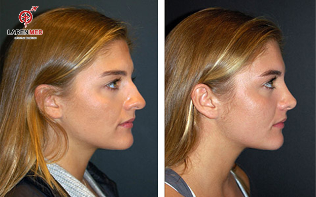 Open vs. Closed Rhinoplasty: Which Method Is Right for You? - Laren Med