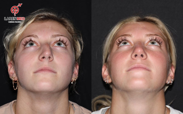 Open vs. Closed Rhinoplasty: Which Method Is Right for You? - Laren Med